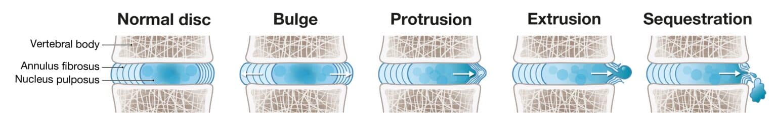 Disc Protrusion: Definition - Spine Info