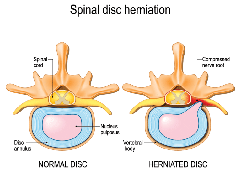 Herniated Disc – Definition, Causes, Symptoms, Diagnosis, and Treatment ... Herniated Disc – Definition, Causes, Symptoms, Diagnosis, and Treatment ...