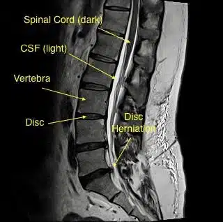 How to Read a Spine MRI - Spine Info