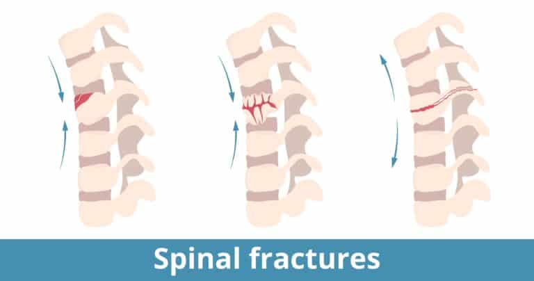 Spinal Fractures: Types, Causes, Symptoms, Diagnosis, and Treatments ...