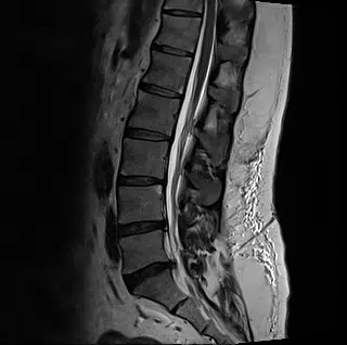 How to Read a Spine MRI - Spine Info
