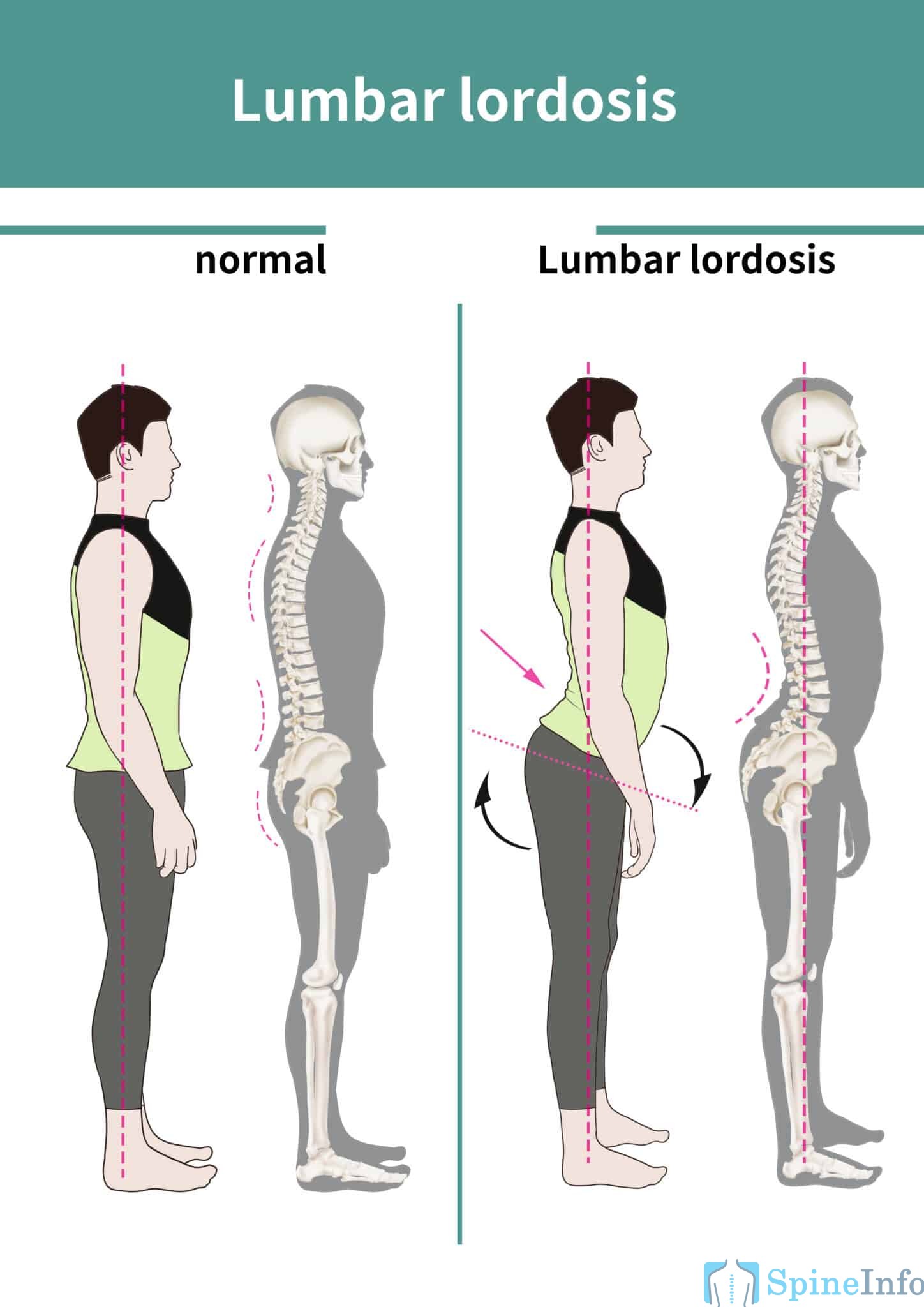 Lumbar Lordosis: Definition, Causes, Symptoms, Diagnosis, and Treatment ...