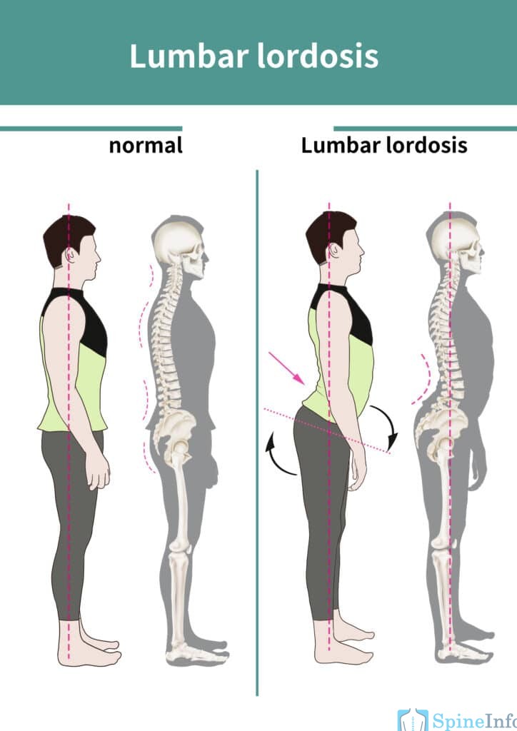 Lordosis: Definition, Causes, Symptoms, Diagnosis, and Treatment ... Lordosis: Definition, Causes, Symptoms, Diagnosis, and Treatment ...