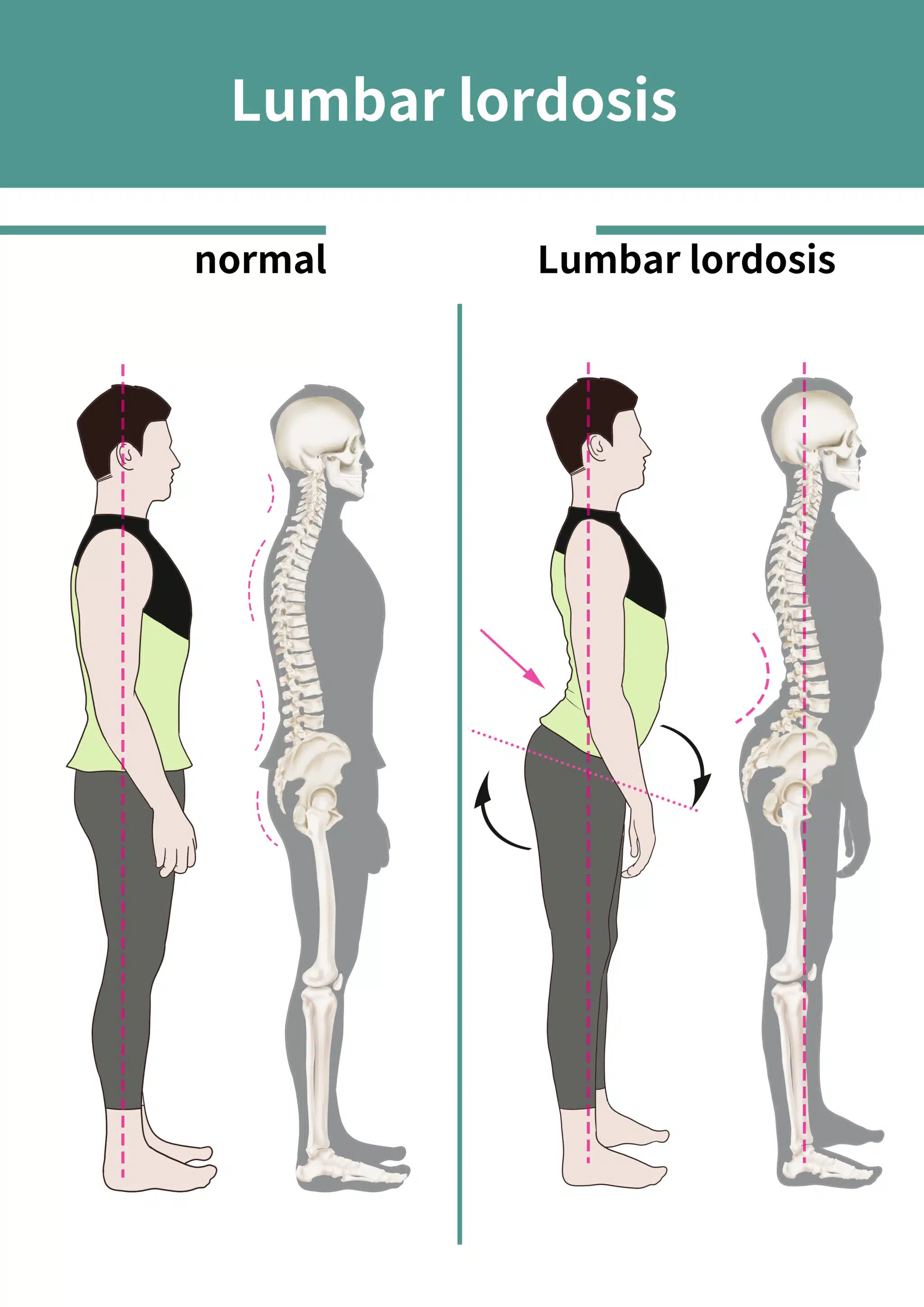 Lordotic Spine Lordotic Spine