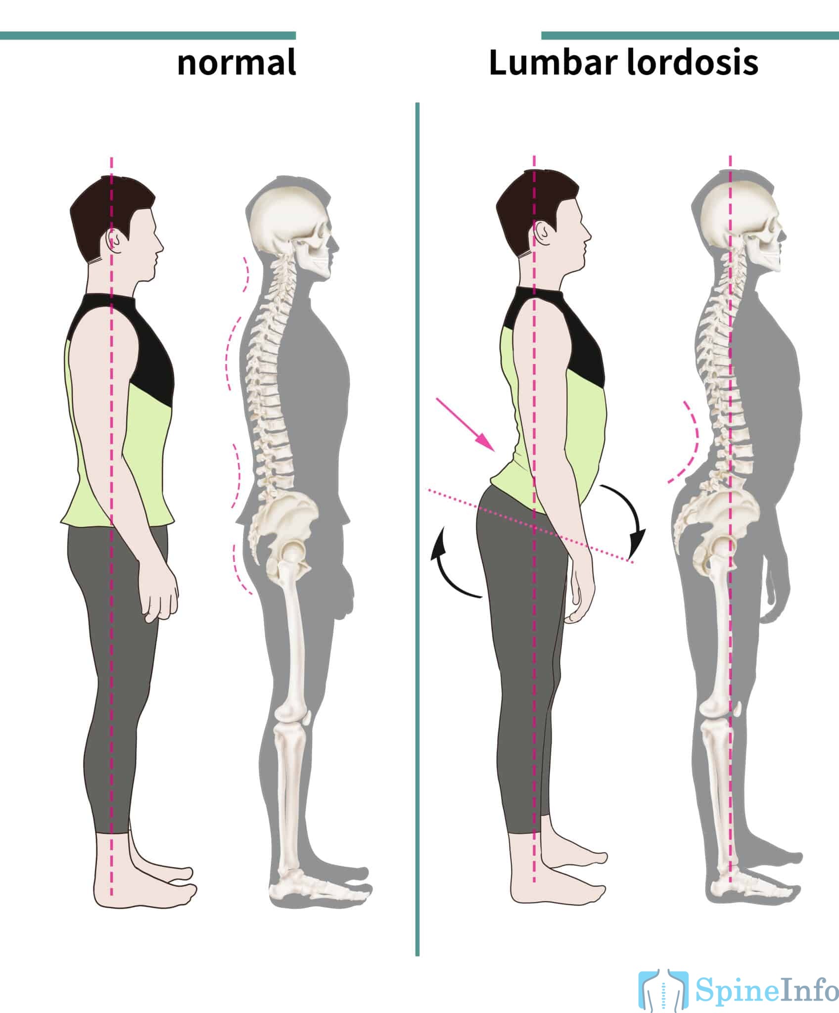 Lumbar Lordosis: Definition, Causes, Symptoms, Diagnosis, and Treatment ...