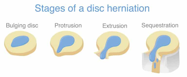 Herniated Disc – Definition, Causes, Symptoms, Diagnosis, and Treatment ...
