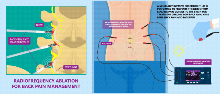 Nerve Ablation / Neurotomy - Spine Info