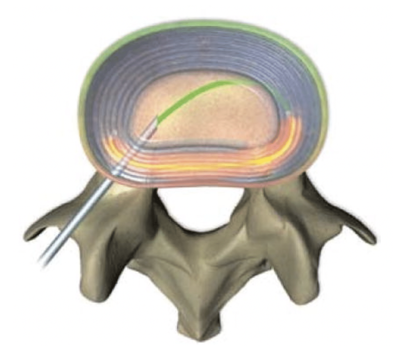 Intradiscal Electrothermal Therapy: Everything you need to know - Spine ...