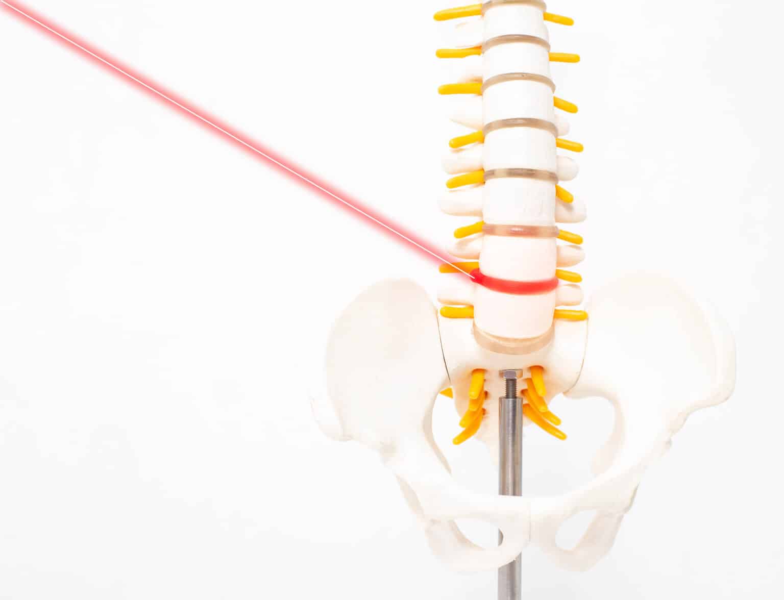 Intradiscal Electrothermal Therapy: Everything you need to know - Spine ...