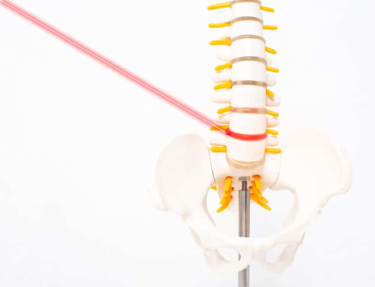 Intradiscal Electrothermal Therapy: Everything you need to know - Spine ...