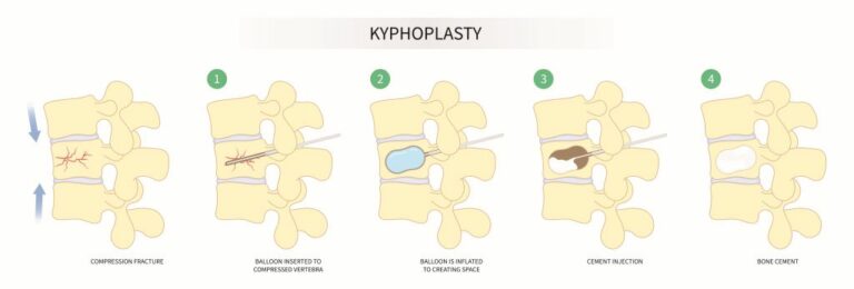 Kyphoplasty: Everything you need to know - Spine Info