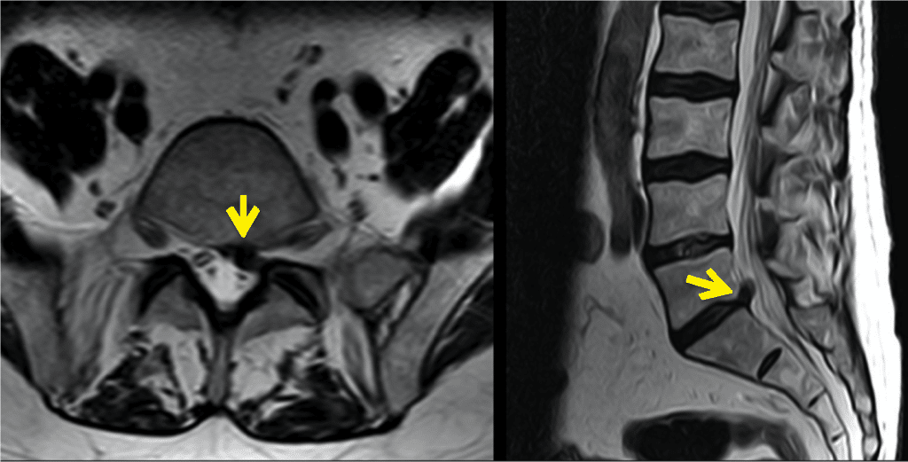 Thecal Sac Effacement Definition Spine Info