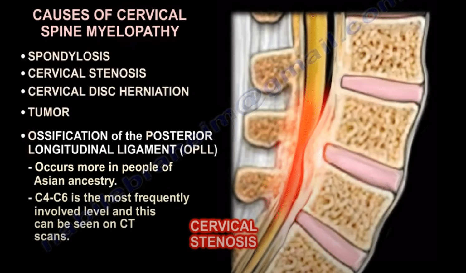 Myelopathy Definition Spine Info Myelopathy Definition Spine Info