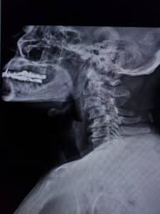 How Serious Is Retrolisthesis? - Spine Info