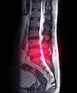 Modic Changes of the Spine: Meaning and Significance - Spine Info