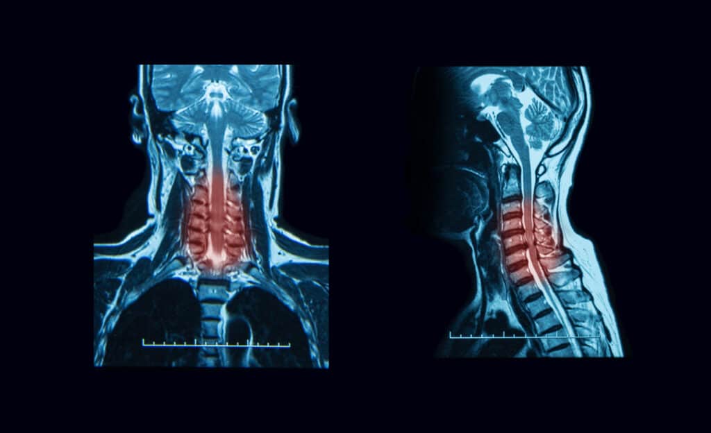 Myelopathy: Definition, Causes, Symptoms, Diagnosis, and Treatment ...
