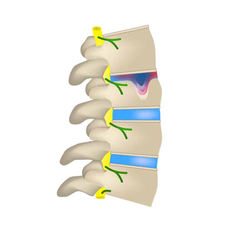 Schmorl's Nodes: Definition, Causes, Symptoms, and Treatment - Spine Info