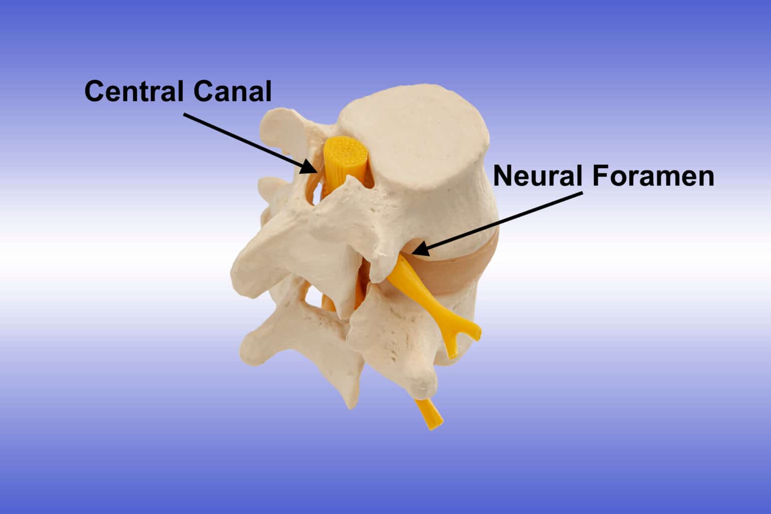 Navigating the Canals of the Spine: Central Canal and Neural Foramen ...